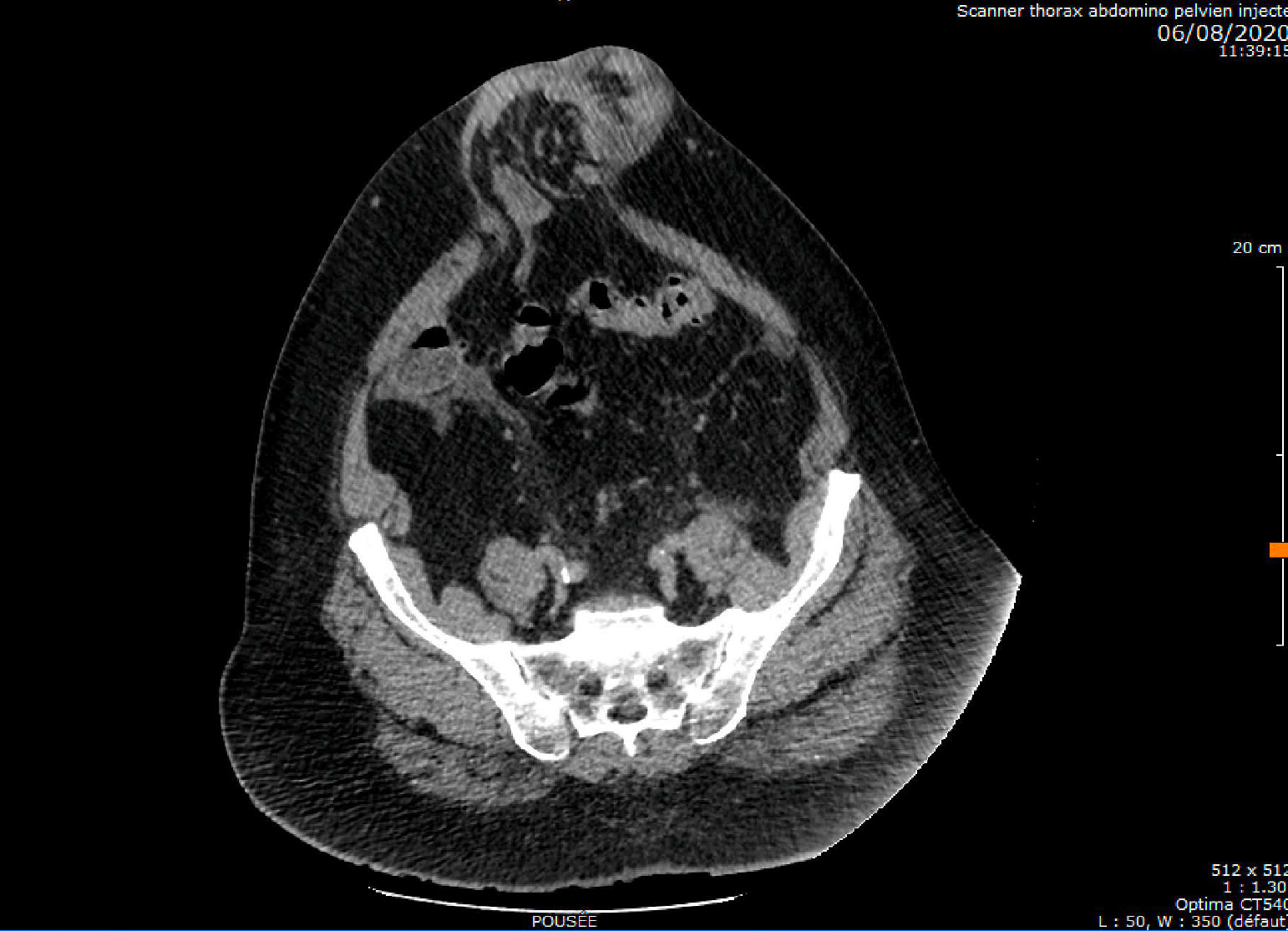 Cure d’éventration - Chirurgie Digestive Montpellier
